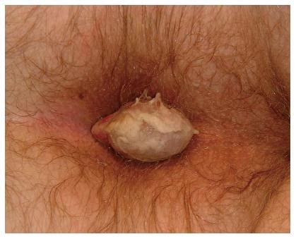 Early Stage Anal Tumor
