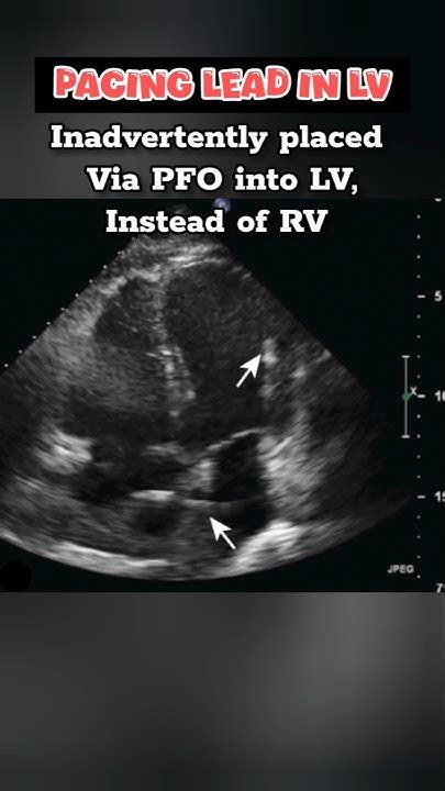 Pacemaker Lead In Lv On Echocardiography Heart Youtube