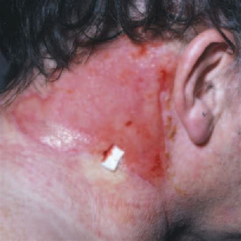 Factitial Dermatitis Semantic Scholar