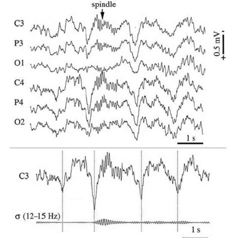 Intracranial Eeg Electrodes A Strip Electrode Targeting The Download Scientific Diagram