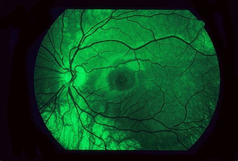 Pattern Dystrophy Retina Image Bank