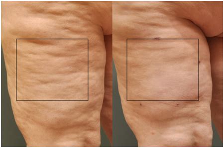 Best Cellulite Treatment For Men And Women Builtlean
