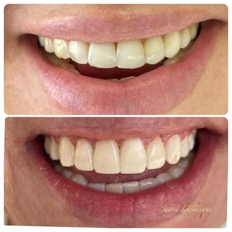 Diseño De Sonrisa En Cali Dra Sara Restrepo