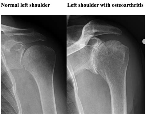 X Ray Normal Shoulder