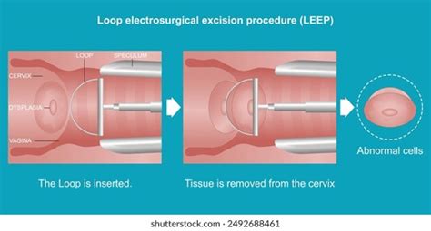 Leep Loop Electrosurgical Excision Procedure Tests Stock Vector Royalty Free 2492688461