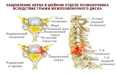Лечение при защемлении нерва: Защемление седалищного нерва: симптомы и ...