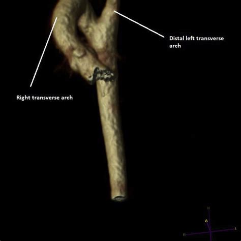 three dimensional computed tomography reconstruction confirms the