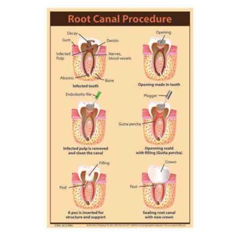 Root Canal Chart Taj Scientific Online Store