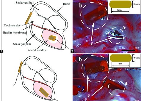 A Illustrations Of Intracochlear Stimulation In Cases Where The Download Scientific Diagram
