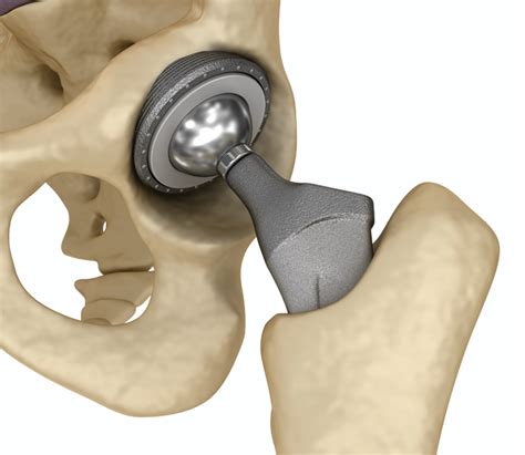 Best Of 2018 Minimizing Destructive Material Testing Todays Medical Developments