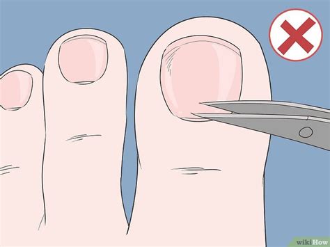 How To Treat An Infected Hangnail Future Prevention