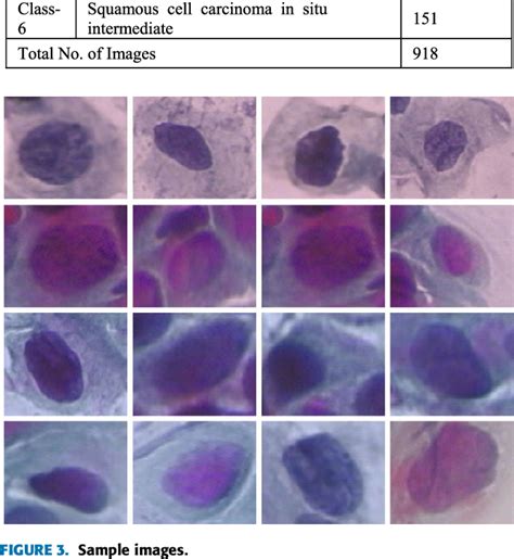 Figure 1 From Improved Bald Eagle Search Optimization With Deep Learning Based Cervical Cancer