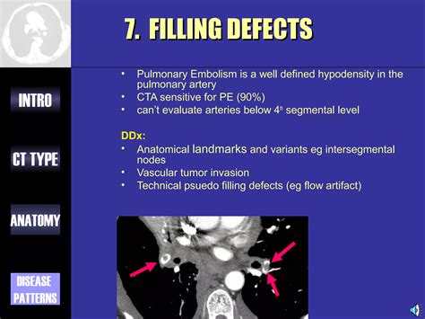 Approach To Ct Chest 578 Ppt