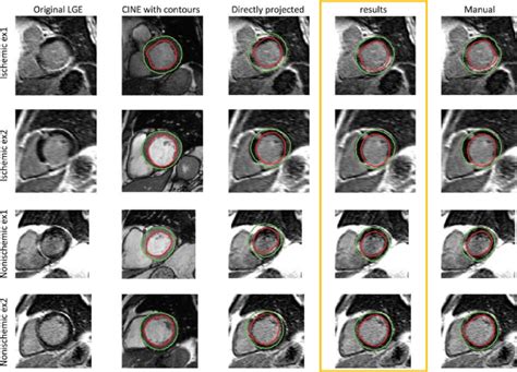 Examples Of The Lv Segmentation Results From Left To Right Original