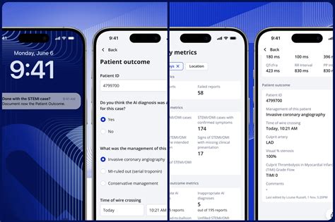 Stemi Ecg Criteria Key Insights Into Ischemic St Elevation Patterns
