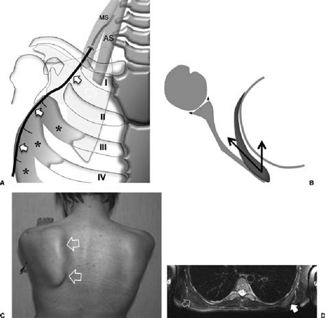 Long Thoracic Nerve Diagram
