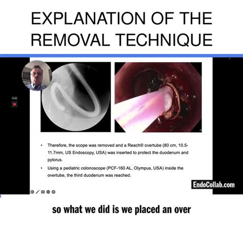 Klaus Mönkemüller On Linkedin Explanation Of The Removal Technique