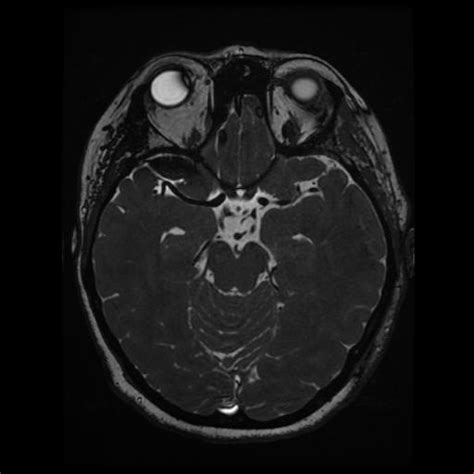 Neurovascular Compression Syndrome Trigeminal Nerve Radiopaedia 89835 106947 Axial Fiesta