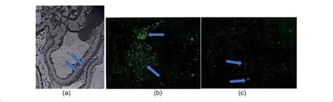 Electron Microscopy Showing Podocyte Effacement From The Glomerular