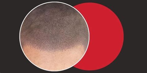 Scalp Micropigmentation In Chennai