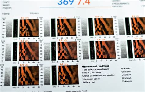 Fibroscan Examination Study Of The Liver Revealed F2 For Liver
