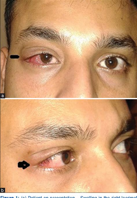 Lacrimal Gland Infection