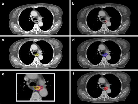 Manual Gross Tumor Volume Gtv Delineation On A Ct Alone B Fused Download Scientific Diagram