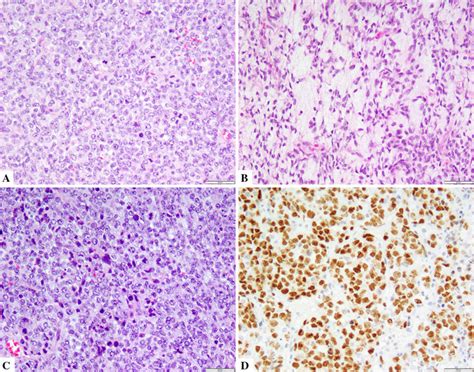 histologic spectrum of cic rearranged sarcoma crs tumors were