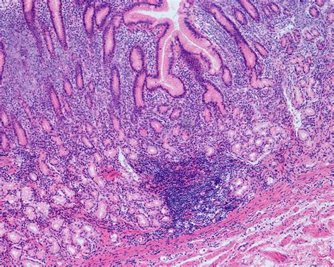 Chronic Gastritis Light Micrograph Stock Image C056 0789 Science Photo Library