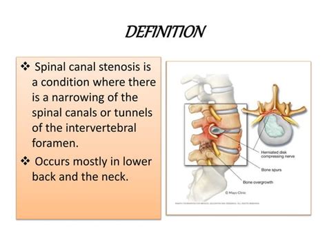 Spinal Canal Stenosis Pptx Definition Classification Pathophysiology Clinical Features