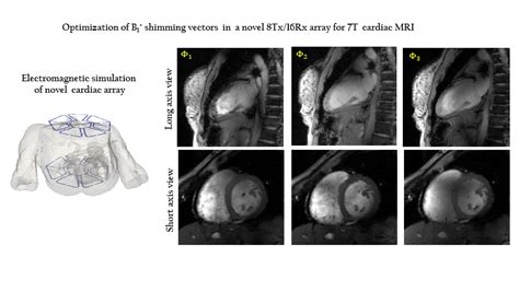 Universitätsklinikum Würzburg Cardiovascular Imaging 7t Cardiac Mri In Human Subjects