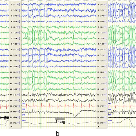 Changes In EEG Patterns Example Of Portions Of An EEG Recording During Download Scientific