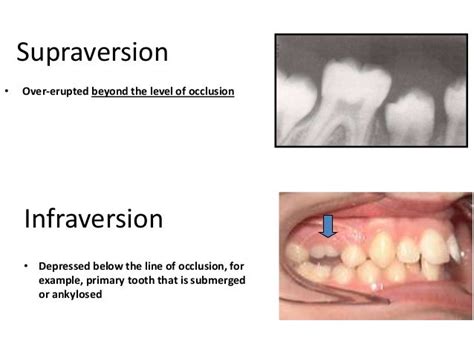 Classification Of Occlusion And Malocclusion Dr Nabil Al Zubair