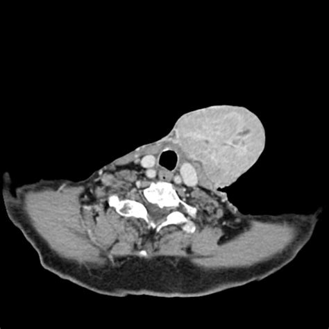 Ct Revealed A Solid Irregular With Increased Vascularity Thyroid‐bed Download Scientific