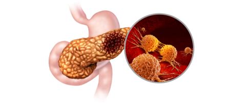 Drug Resistant Pockets In Pancreatic Cancer Biotechniques