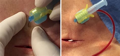 Mechanical Complications Of Implantable Ports A Testimonial Of Dr Jean Jacques Simon VascuFirst