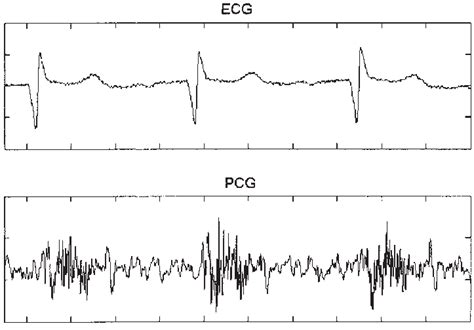 Simultaneous Ecg And Phonocardiography Recordings Of A Patient With Download Scientific Diagram