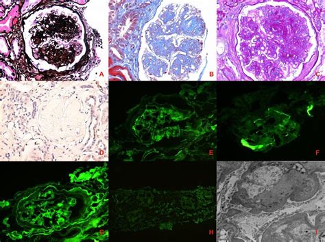 Idiopathic Nodular Glomerulosclerosis And Differential Diagnosis