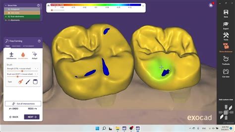 Quick Demo Of Exocad Abutment Designing Youtube