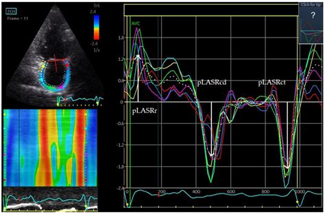Left Atrial Strain Rate Plasrr 13 S⁻¹ Peak Left Atrial Strain Rate Download Scientific