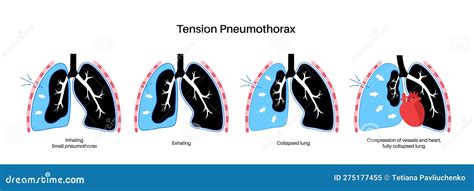 Tension Pneumothorax Poster Cartoon Vector 275372085