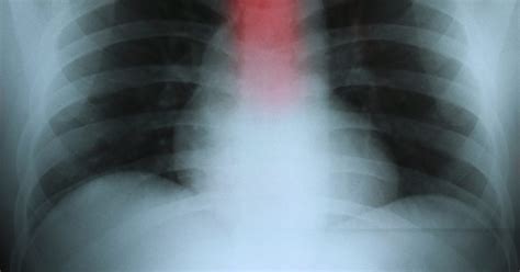 Sine Sclerosis Scleroderma News