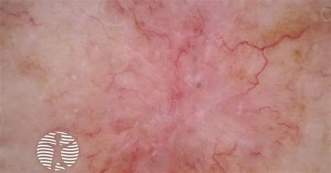 Basal Cell Carcinoma Dermoscopy Image