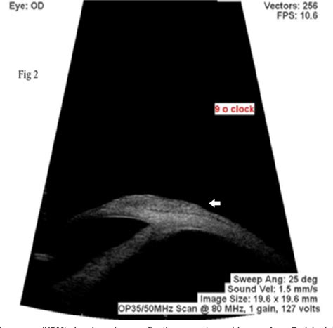 Figure 2 From Ocular Surface Squamous Neoplasia Masquerading As