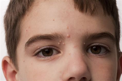 Mollusken Contagiosa Molluscum Contagiosum