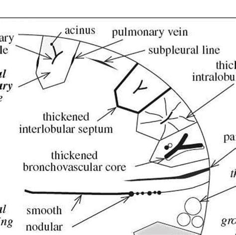 Dr Saburi Radiologist On Instagram Lung Pattern In Hrct Medical Radiography Radiology