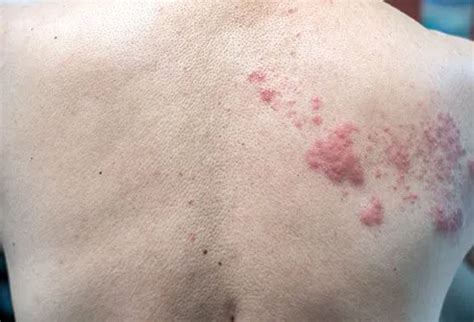 What Does A Shingles Rash Look Like At First