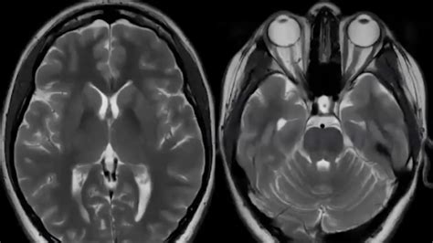 Overview Of Csf Flow Mri Online Is Now Medality