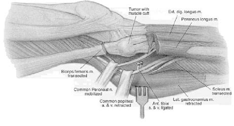 This Figure Depicts A Type I En Bloc Resection Of A Proximal Fibula