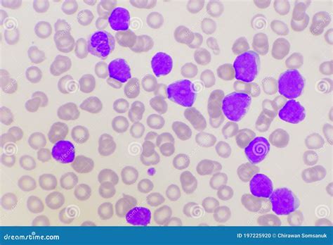 Mixed Cell Leukemia At Leona Freedman Blog